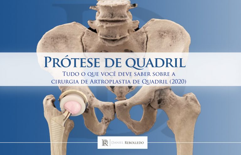 PROTESE DE QUADRIL: Guia Completo sobre a cirurgia de artroplastia de ...